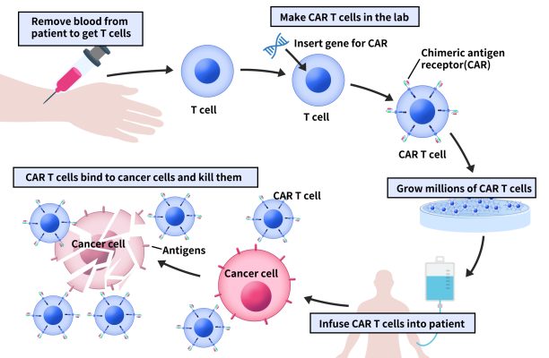 Unraveling the Mystery of 'Million-Dollar' CAR-T Therapy - DIMA ...